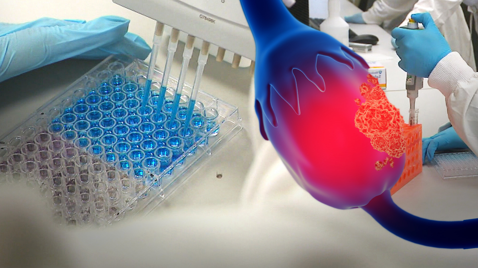 WATCH: New ovarian cancer test to be trialled